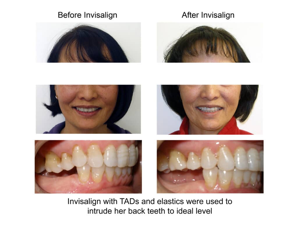 Invisalign Before and After | Yang Orthodontics