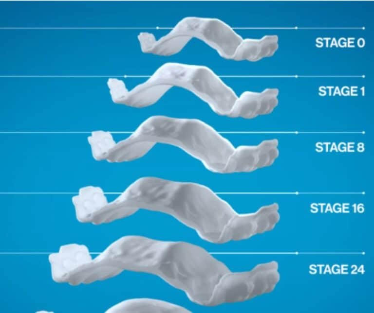 Invisalign® Expanders | Yang Orthodontics